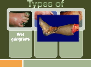 Gangrena de fournier | PPTX