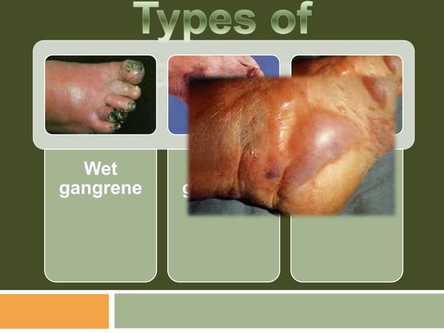 Gangrena de fournier | PPTX