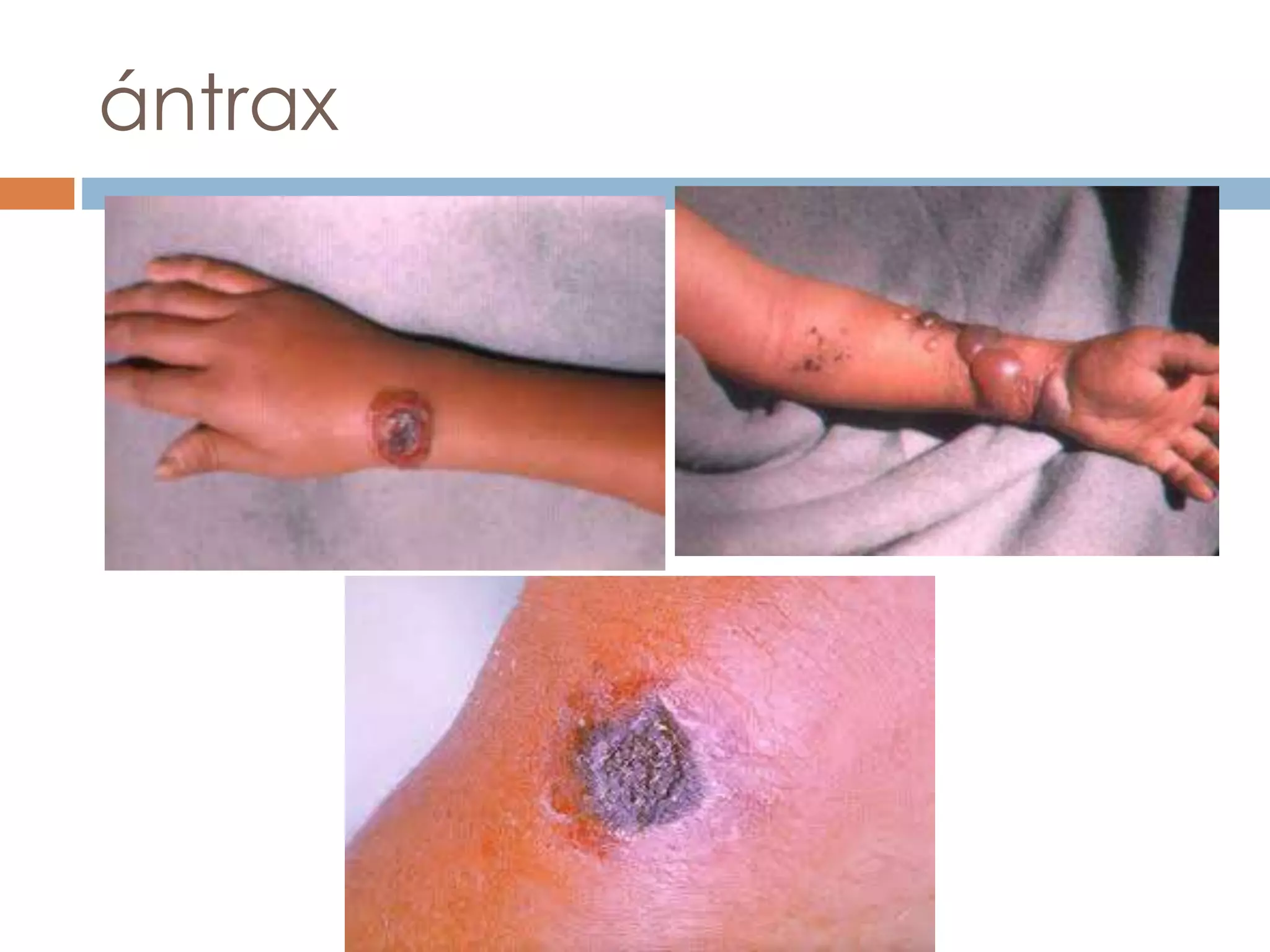 Gangrena gaseosa | PPTX | Infectious Diseases | Diseases and Conditions