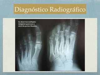 Gangrena gaseosa | PDF