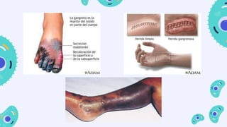 Gangrena gaseosa.pptx