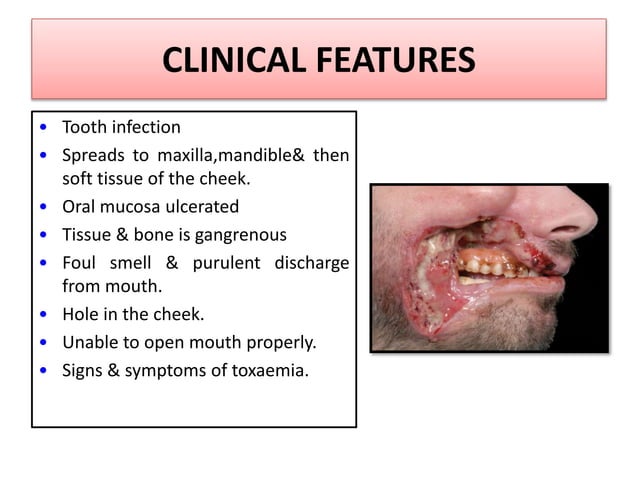 Gangrene | PPTX
