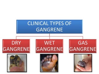 Gangrene PPT Gangrene PPT