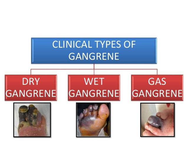 Gangrene