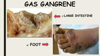CELL INJURY-II Gangrene | PPTX