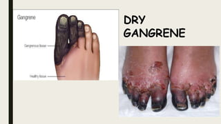 CELL INJURY-II Gangrene | PPT