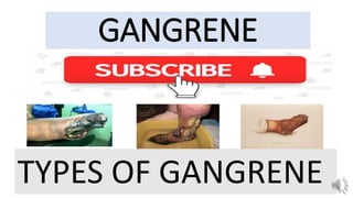 Gangrene #Types of gangrene | PPTX