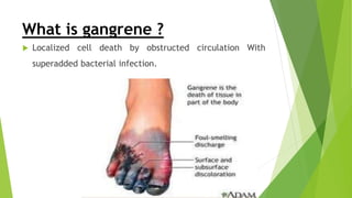Gangrene | PPTX