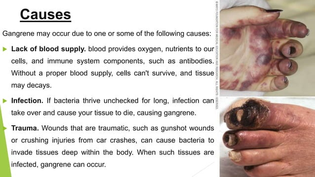 Gangrene | PPTX