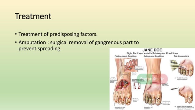 Gangrene | PDF | Diseases and Conditions | Medical Health