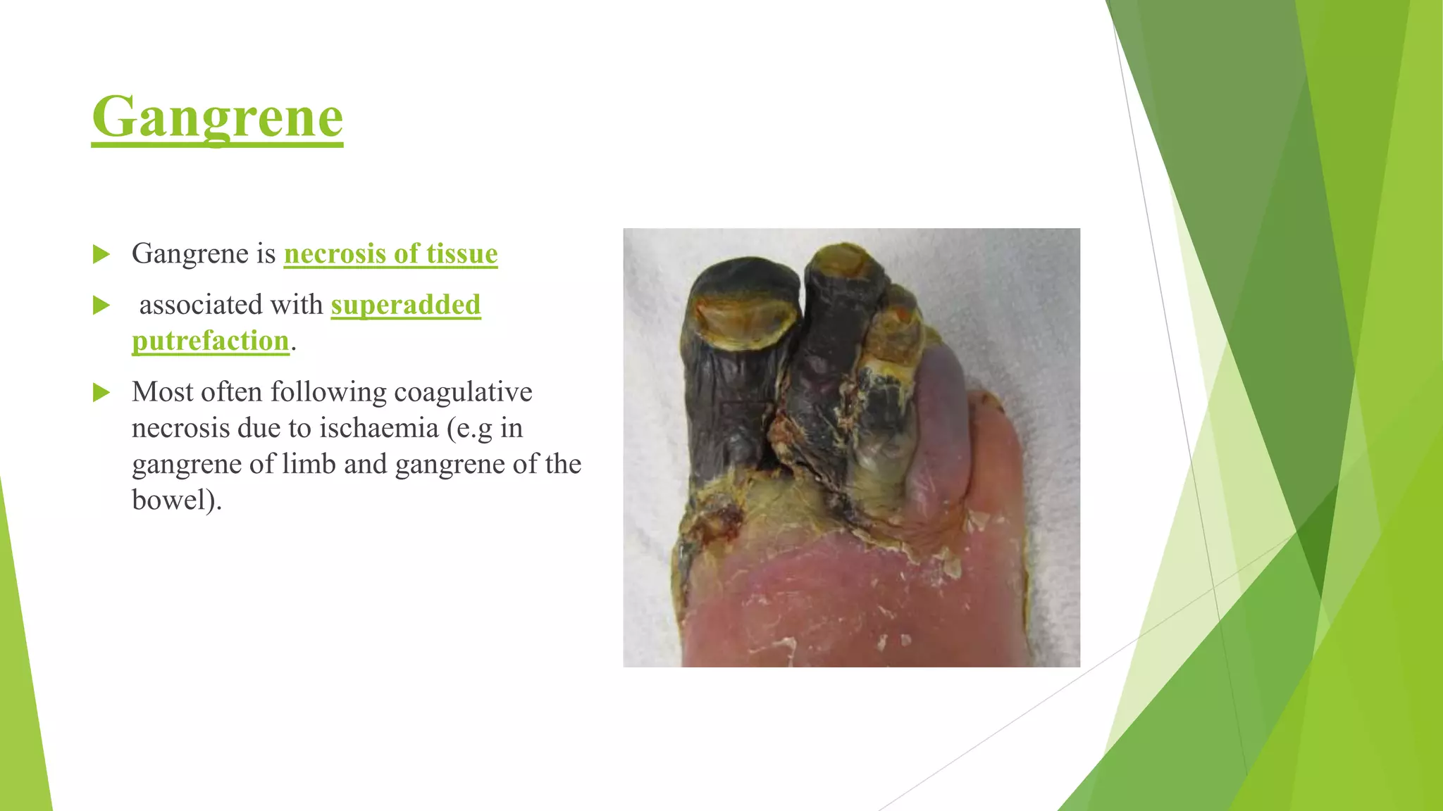 Gangrene.pptx