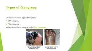 Gangrene.pptx