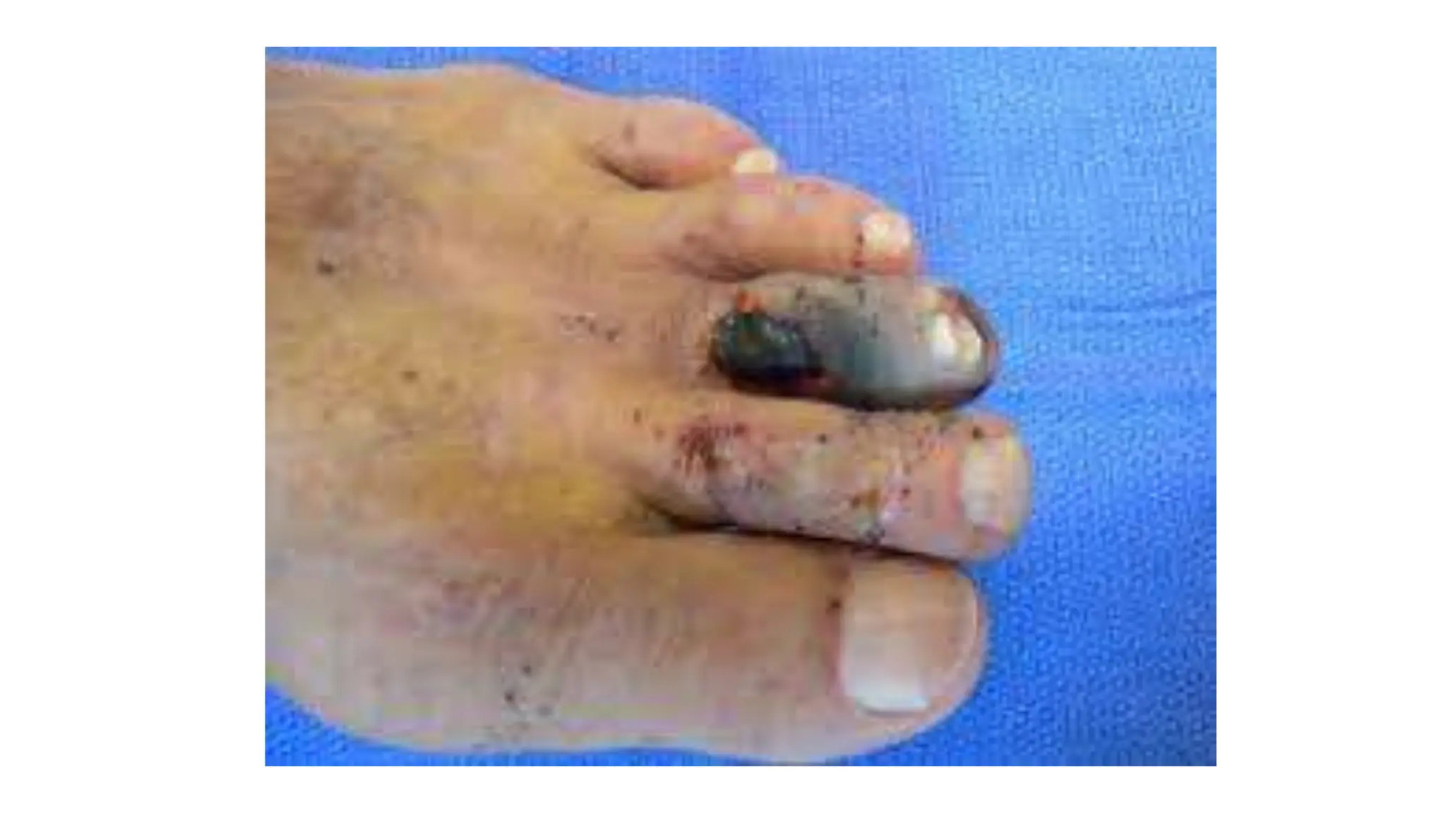 GANGRENE Macroscopic death of tissue with putrefaction. Pre gangrene ...