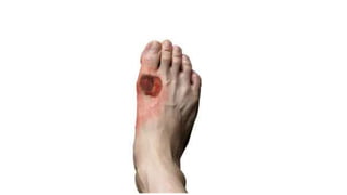 GANGRENEMacroscopic death of tissue with putrefaction. Pre gangrene ...