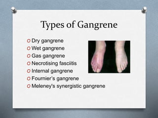 gangrene_2.pptx