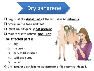 Gangrene and amputation | PPTX