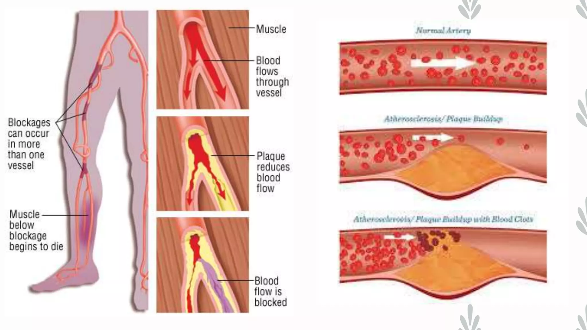 Gangrene + peripheral vascular diseases | PPTX