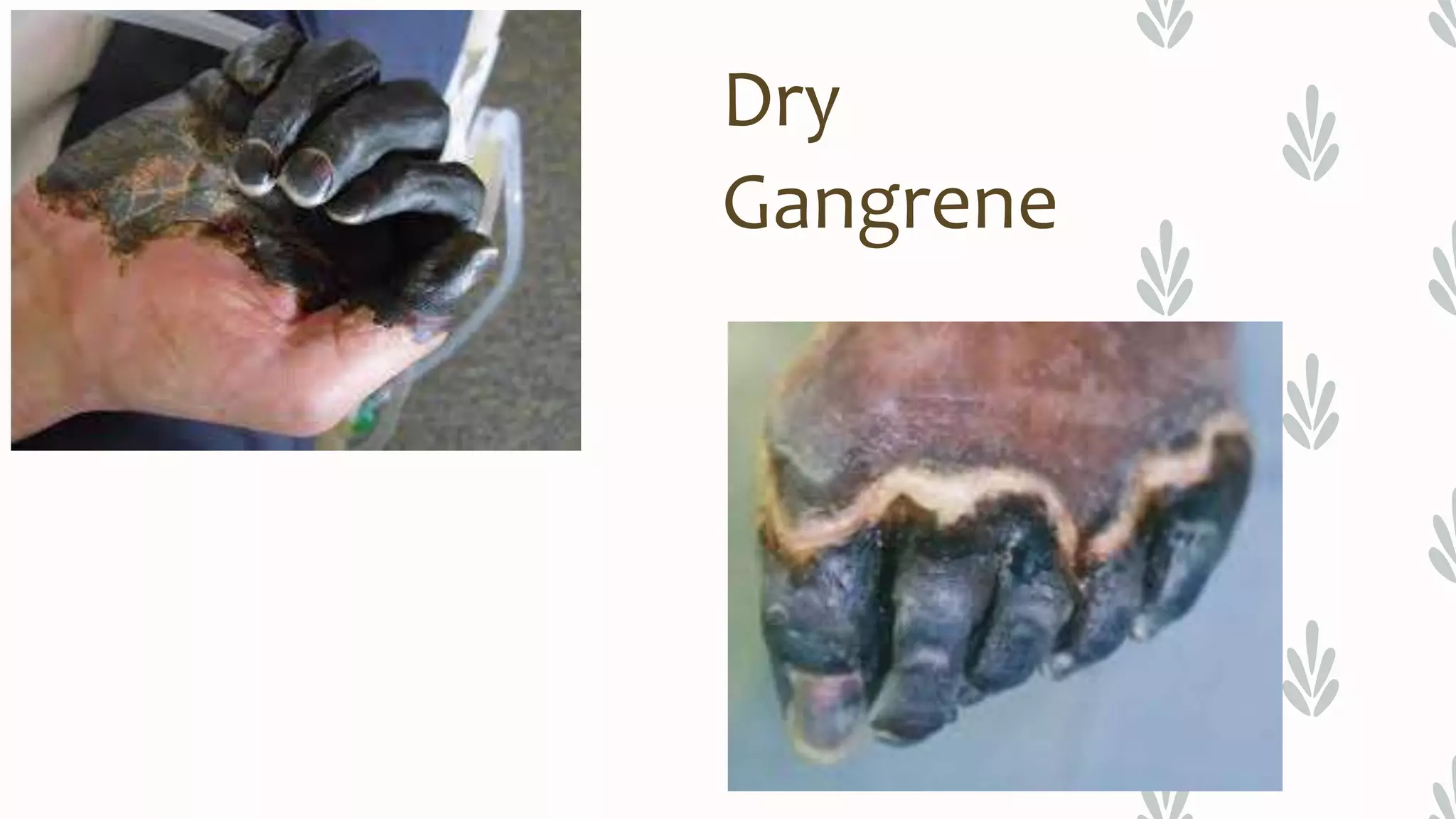 Gangrene + peripheral vascular diseases | PPTX