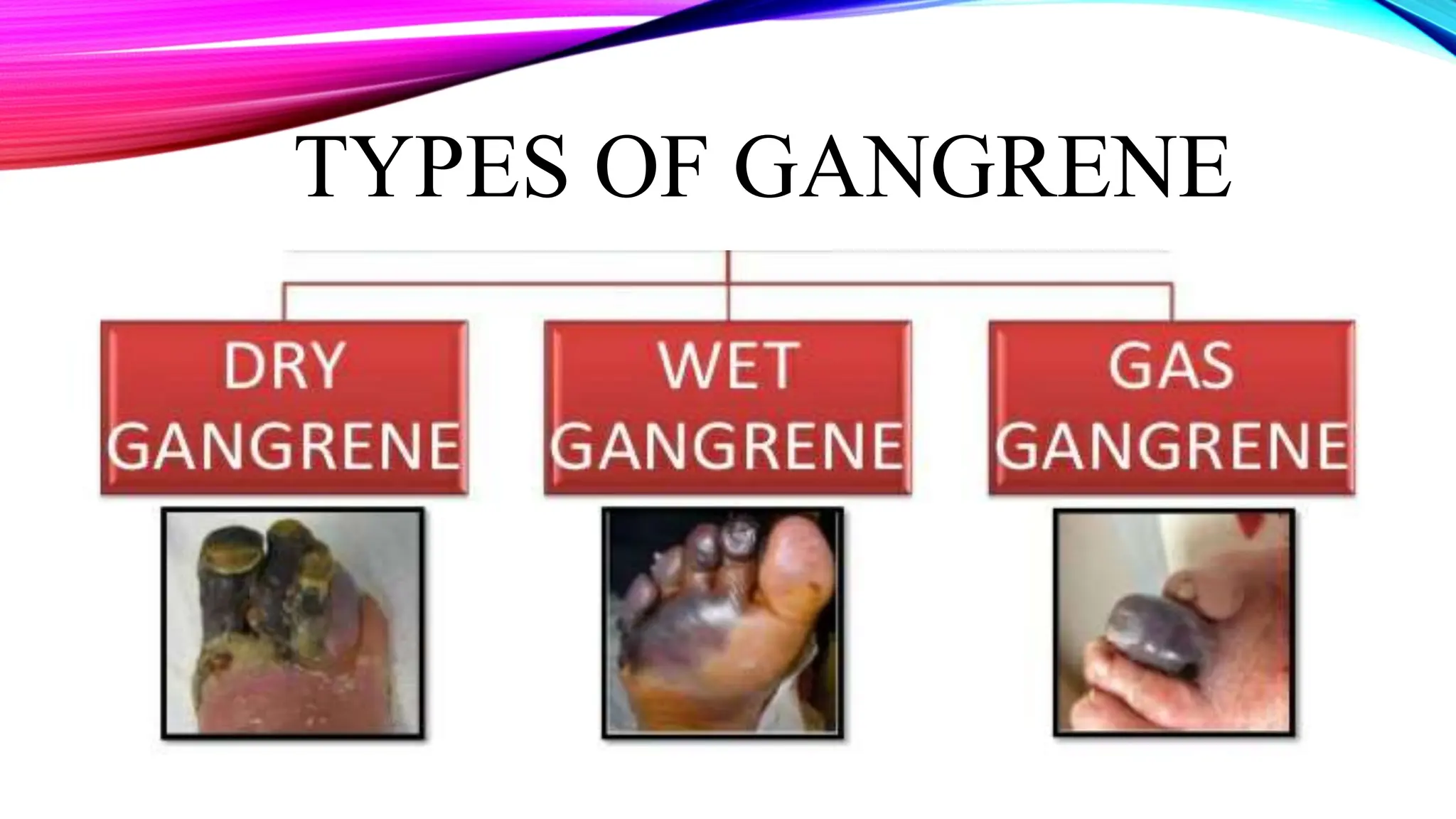 Gangrenepresentation pptx For Healthcare PPTX
