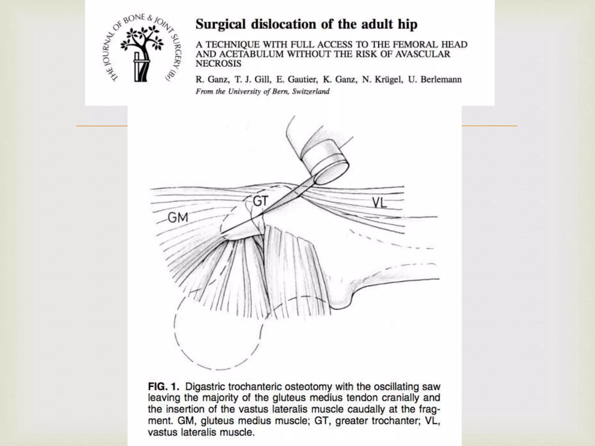 reduction of a chronic posterior hip dislocation using a Ganz trochanteric osteotomy | PPT