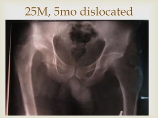 reduction of a chronic posterior hip dislocation using a Ganz ...