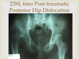 reduction of a chronic posterior hip dislocation using a Ganz ...
