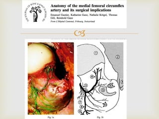 reduction of a chronic posterior hip dislocation using a Ganz ...