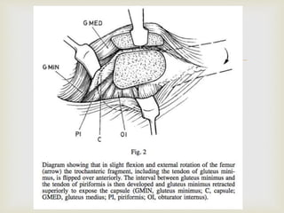 reduction of a chronic posterior hip dislocation using a Ganz ...