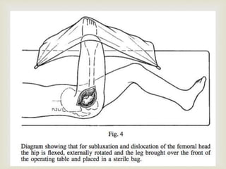 reduction of a chronic posterior hip dislocation using a Ganz ...