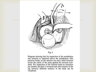 reduction of a chronic posterior hip dislocation using a Ganz ...