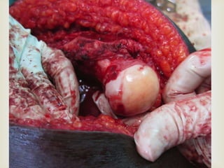 reduction of a chronic posterior hip dislocation using a Ganz ...