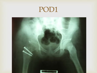reduction of a chronic posterior hip dislocation using a Ganz ...
