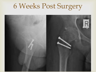reduction of a chronic posterior hip dislocation using a Ganz ...