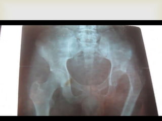 reduction of a chronic posterior hip dislocation using a Ganz ...