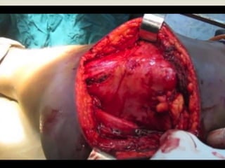 reduction of a chronic posterior hip dislocation using a Ganz ...