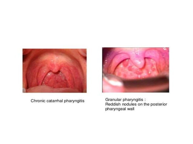 Sore Throat. ppt | PPTX