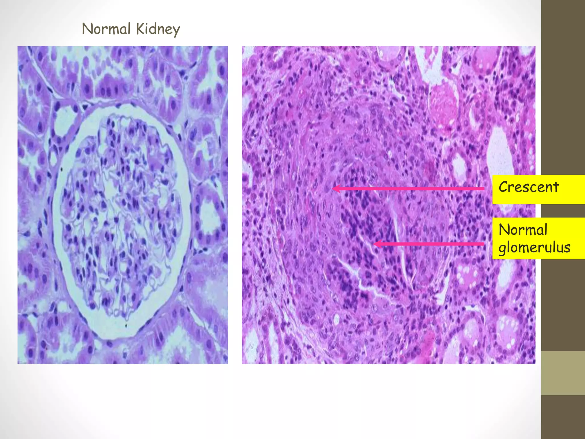 Approach to Rapidly Progressive Glomerulonephritis RPGN | PPT