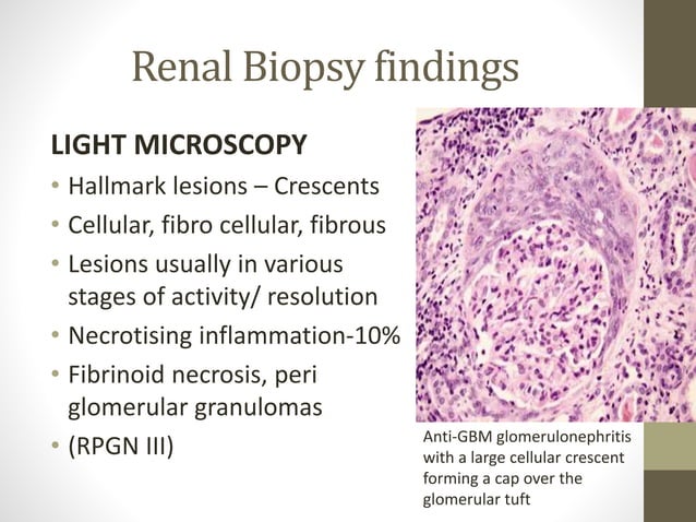 Approach to Rapidly Progressive Glomerulonephritis RPGN | PPTX ...