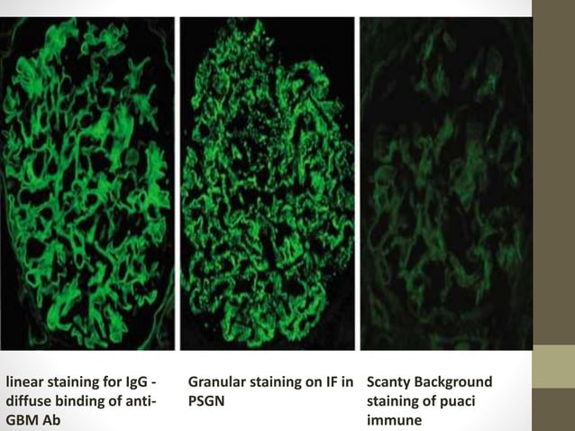 Approach to Rapidly Progressive Glomerulonephritis RPGN | PPTX ...