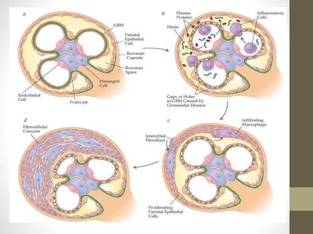 Approach to Rapidly Progressive Glomerulonephritis RPGN | PPTX ...