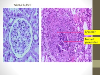 Approach to Rapidly Progressive Glomerulonephritis RPGN | PPTX