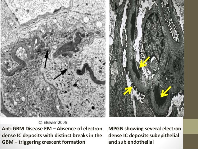 Approach to Rapidly Progressive Glomerulonephritis RPGN