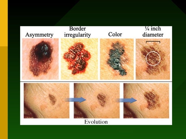 CANCER | PPT | Cancer | Diseases and Conditions