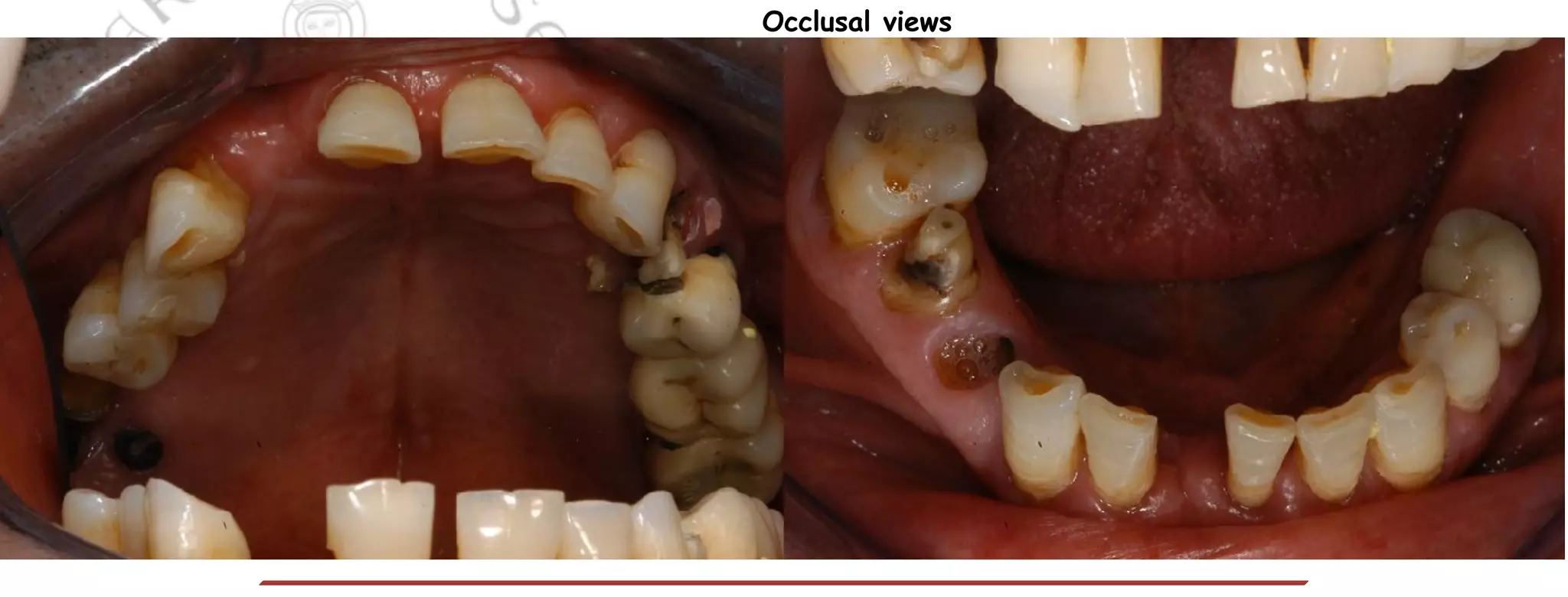Full mouth rehabilitation of periodontal involved teeth with Aadva NT ...
