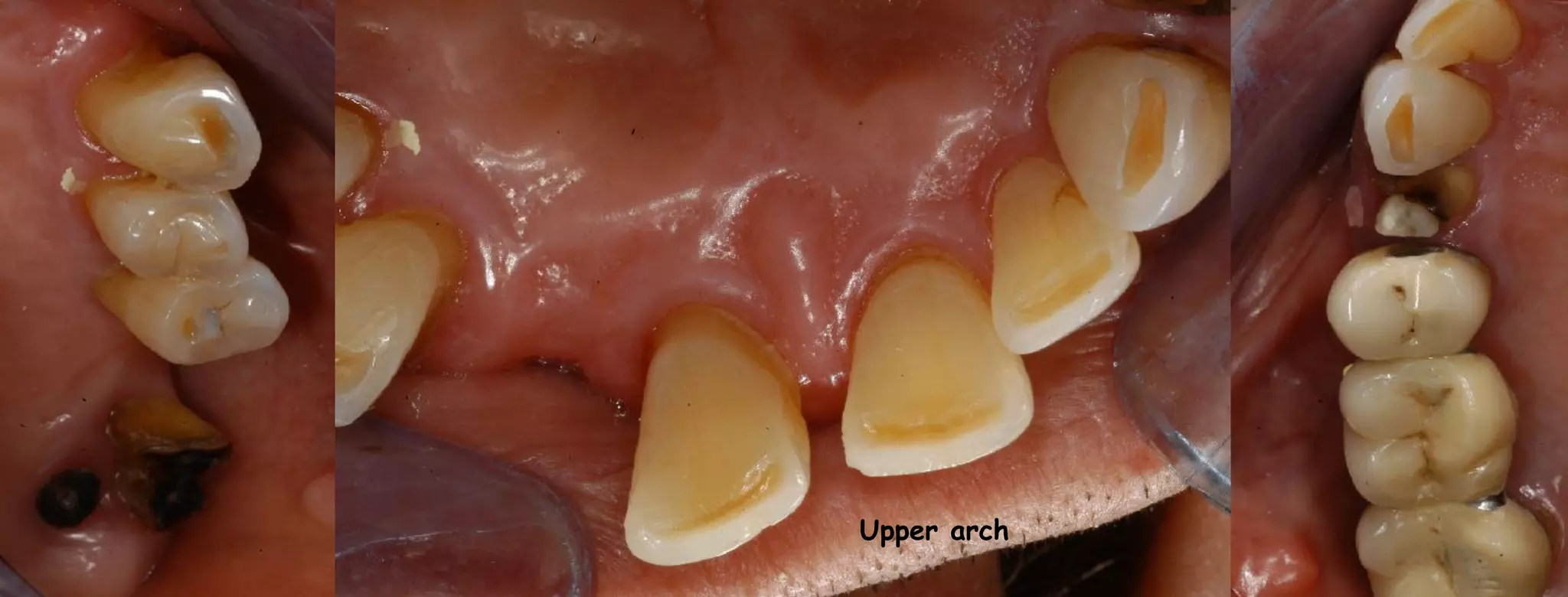 Full mouth rehabilitation of periodontal involved teeth with Aadva NT ...