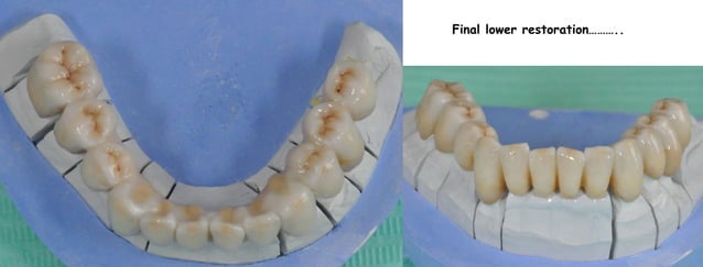 Full mouth rehabilitation of periodontal involved teeth with Aadva NT ...