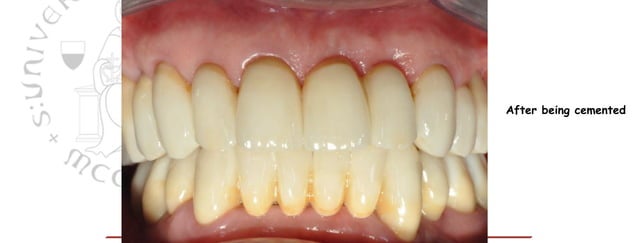 Full mouth rehabilitation of periodontal involved teeth with Aadva NT ...