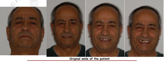 Full mouth rehabilitation of periodontal involved teeth with Aadva NT ...