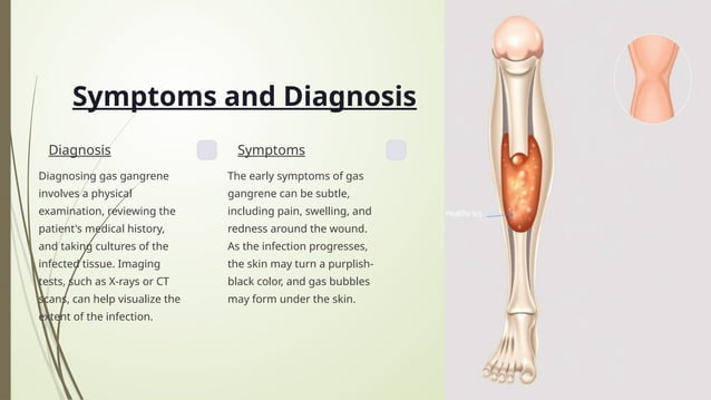 Gas-Gangrene-A-Serious-Bacterial-Infection.pptx