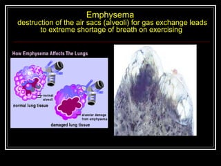 Grade 11 - Gas Exchange and Smoking | PPT